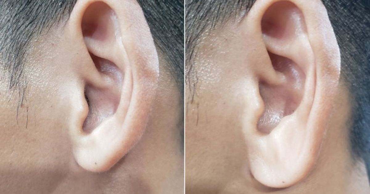 Có nên tiêm tai tài lộc?